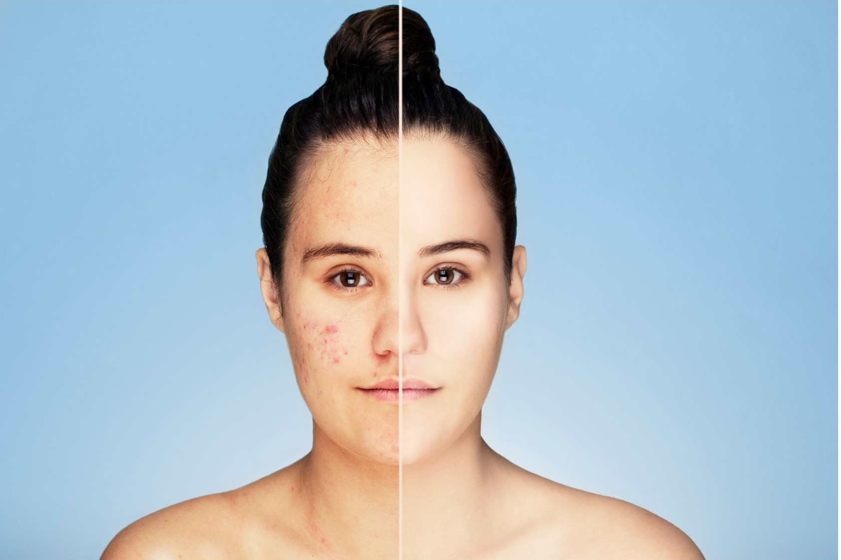 Breakouts, Be Gone! The Real Deal on Acne - Dermatologist Chandler AZ ...
